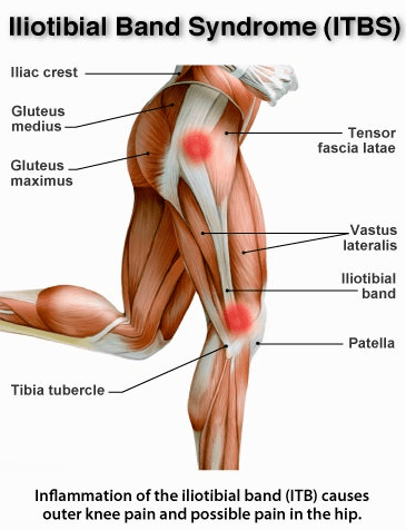 Preventing & Managing Iliotibial Band Syndrome (ITBS) - Stockport Physiotherapy